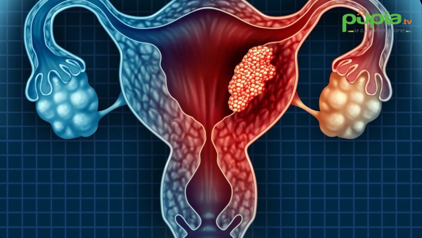 Papilloma Virus e tumore della cervice uterina: convegno di Synlab Sdn ...